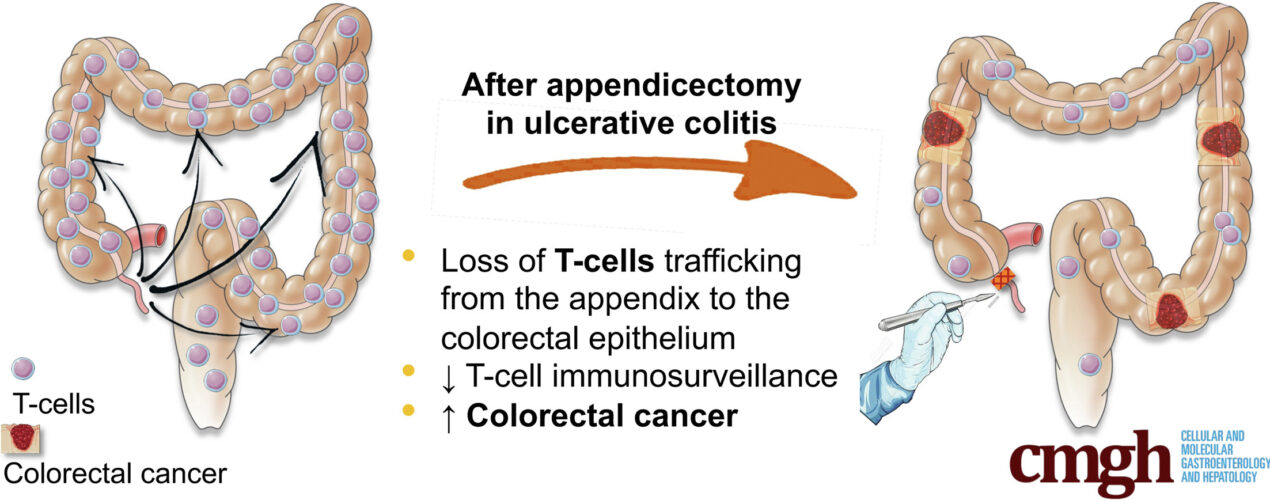 The Appendix Orchestrates T-Cell Mediated Immunosurveillance in Colitis ...